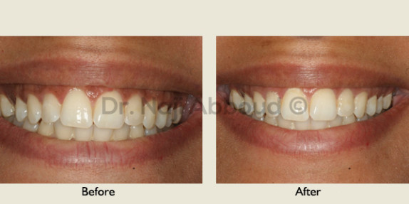 Elimination of Melanin Pigmentation | Perio Implant Clinic