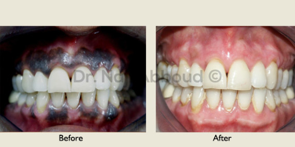 Elimination of Melanin Pigmentation | Perio Implant Clinic